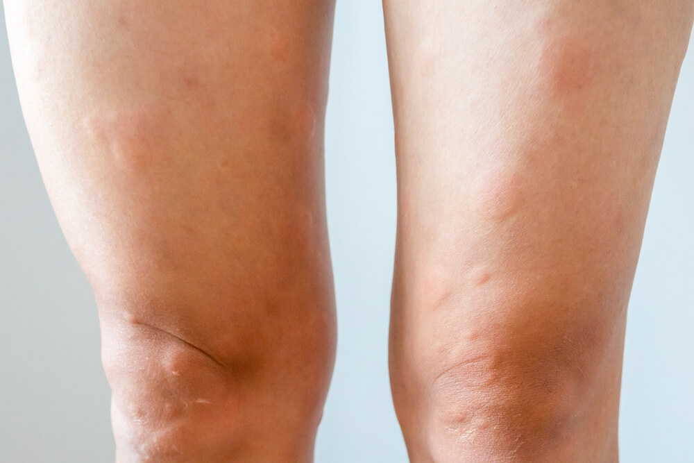 Compressiekous voor het dijbeen? | Verlicht je been | Podobrace