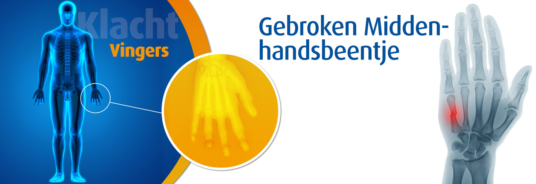 Gebroken middenhandsbeentje: Wat is het? | Podobrace