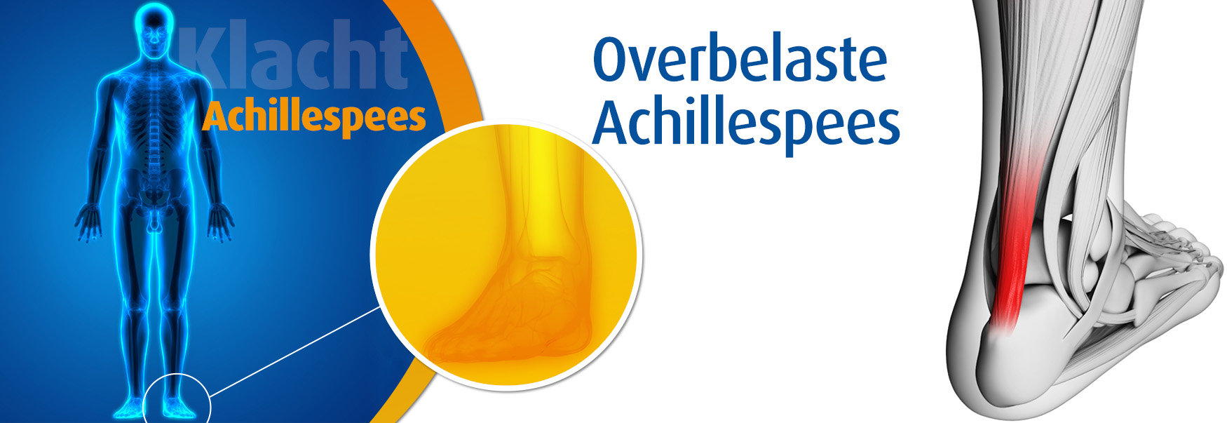 Overbelaste Achillespees: Symptomen & Behandeling | Podobrace