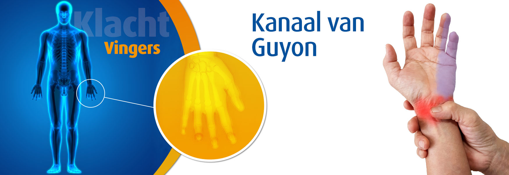 Kanaal van Guyon: Wat is het precies? | Podobrace